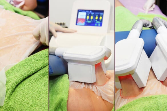 Comparisons – Liposuction vs CoolSculpting